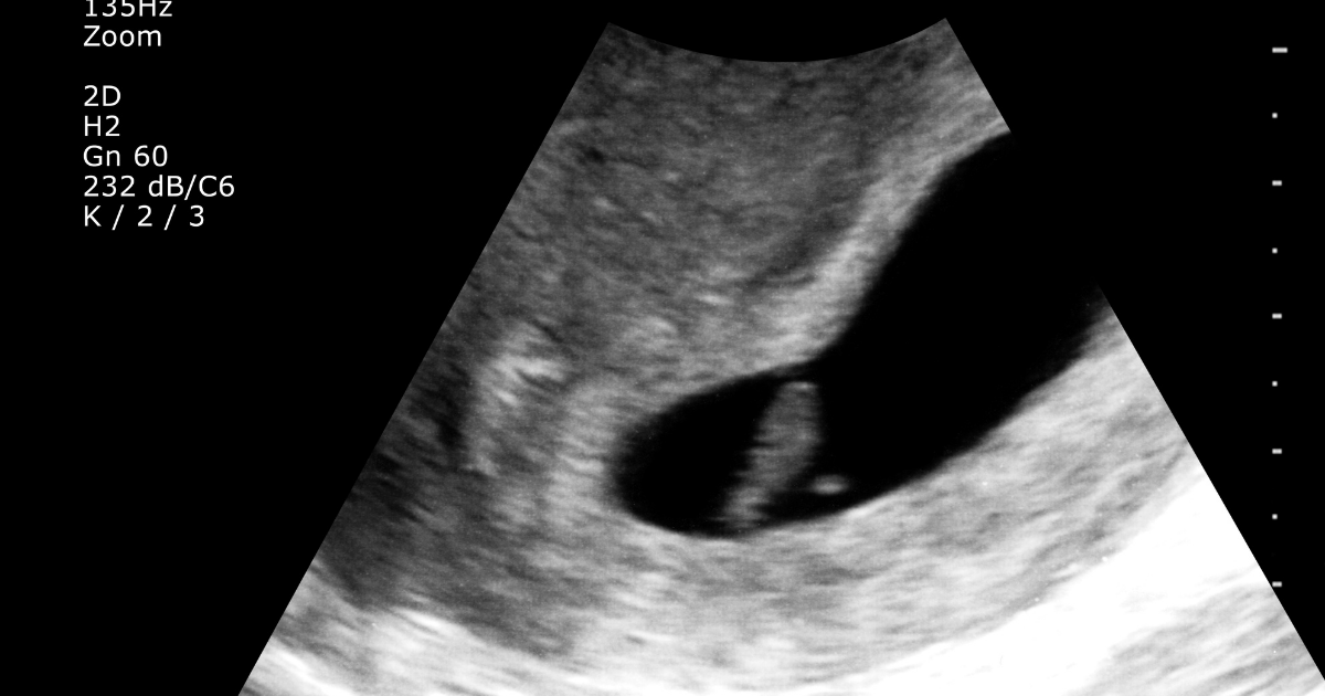 Ramzi Theory: What is it? Is it Accurate? Does it Work? - Pregnant ...